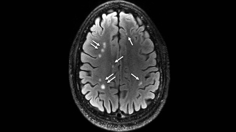 Over half of troops who suffered blast concussions have brain scarring ...