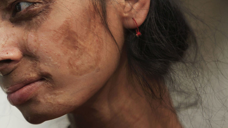 Acid attacks in Britain up 30% as ‘cheaper alternative’ to knives ...